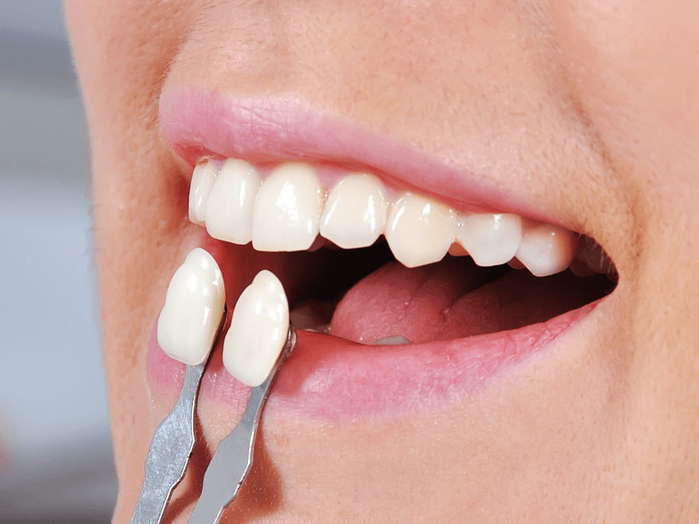 Non-prep facings laten zetten? – Tandarts Morshedi