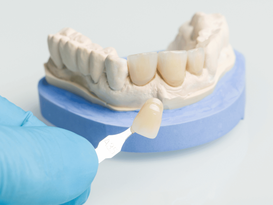 Non-prep Facings Nederland – Tandarts Morshedi