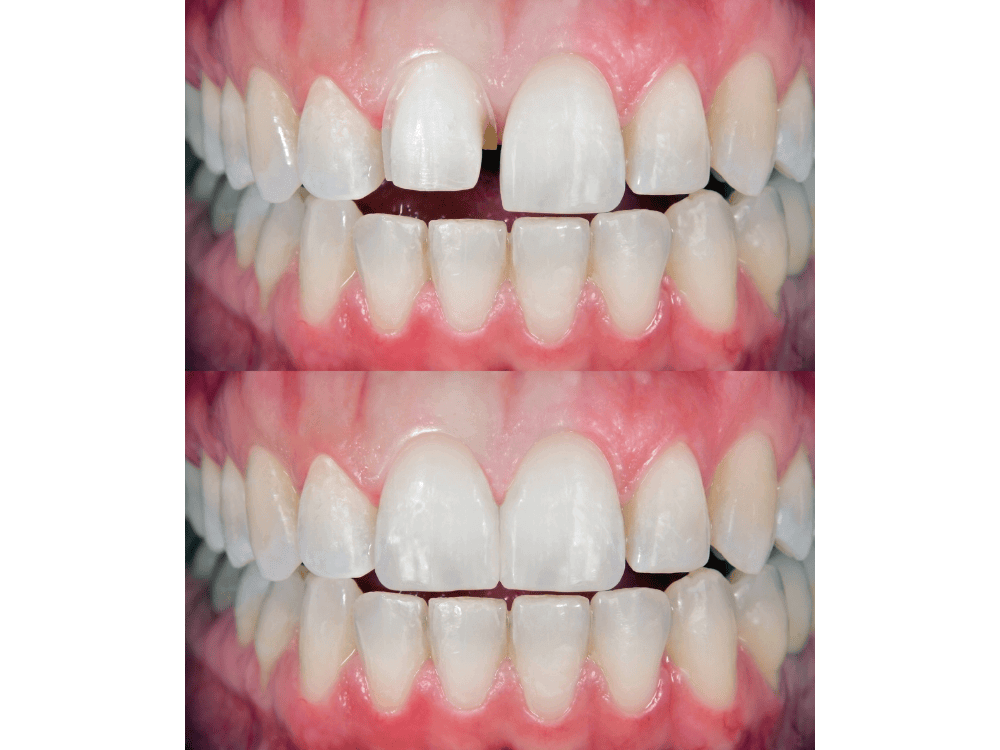 Non-prep Facings Rotterdam – Tandarts Morshedi